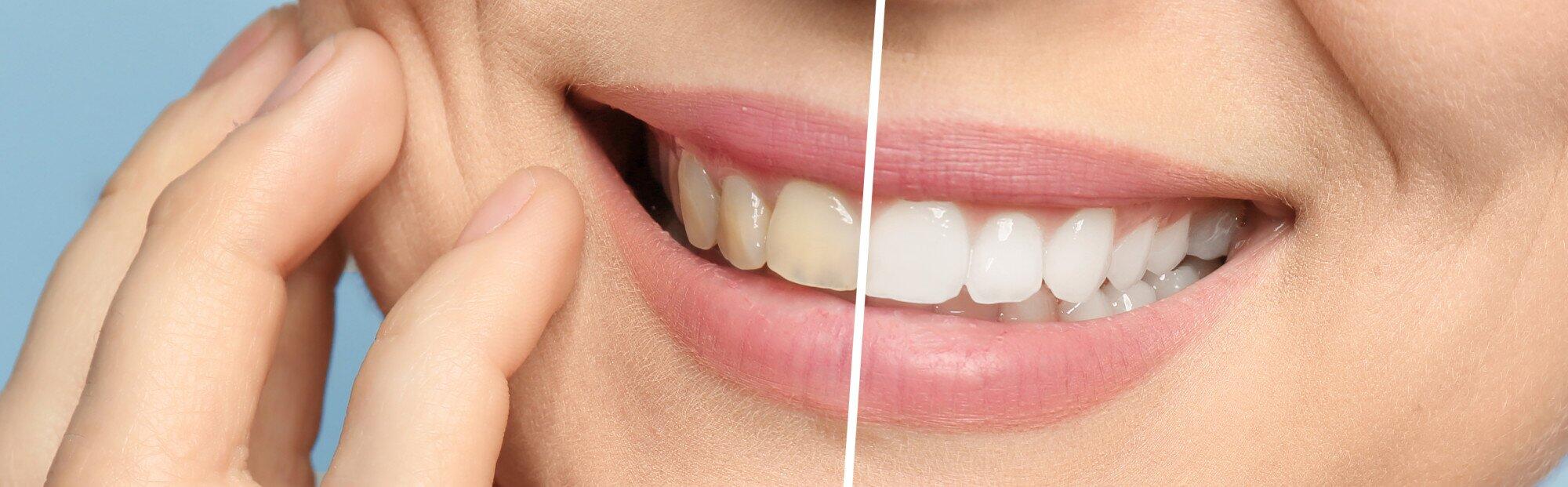Teeth Whitening Cost Comparison: How Different Methods Stack Up